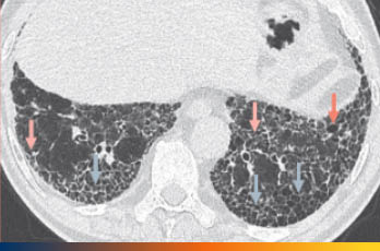 TCAR, Herramienta diagnóstica de la EPID | Avances en Fibrosis Pulmonar