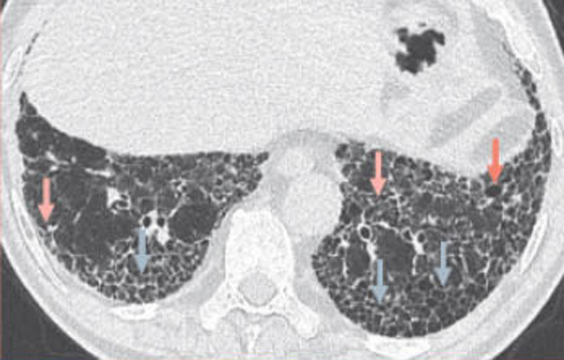 TCAR, Herramienta diagnóstica de la EPID | Avances en Fibrosis Pulmonar