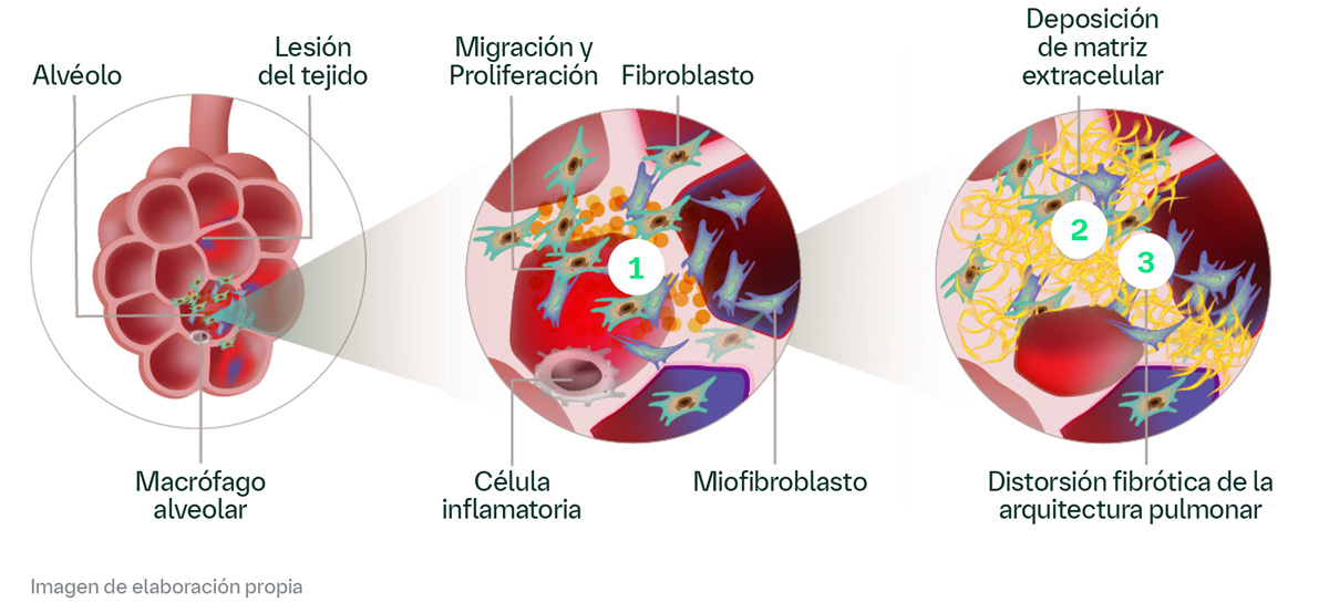 Inflamación y fibrosis en EPID | Avances en Fibrosis Pulmonar